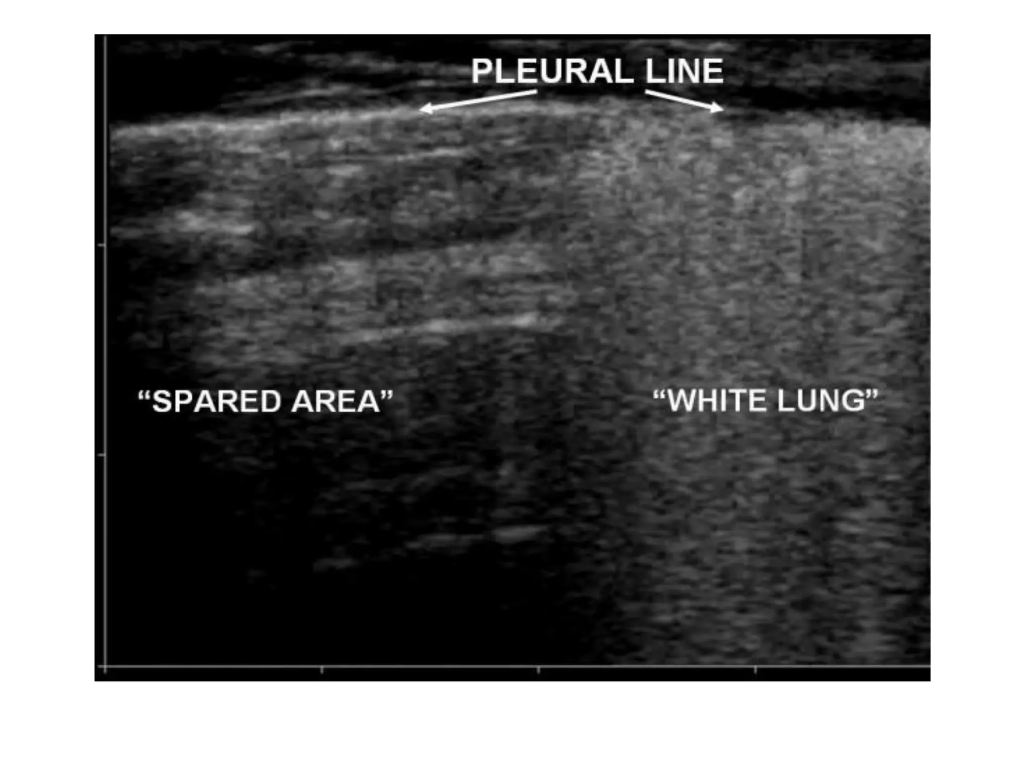 Lung Ultrasound | PDF