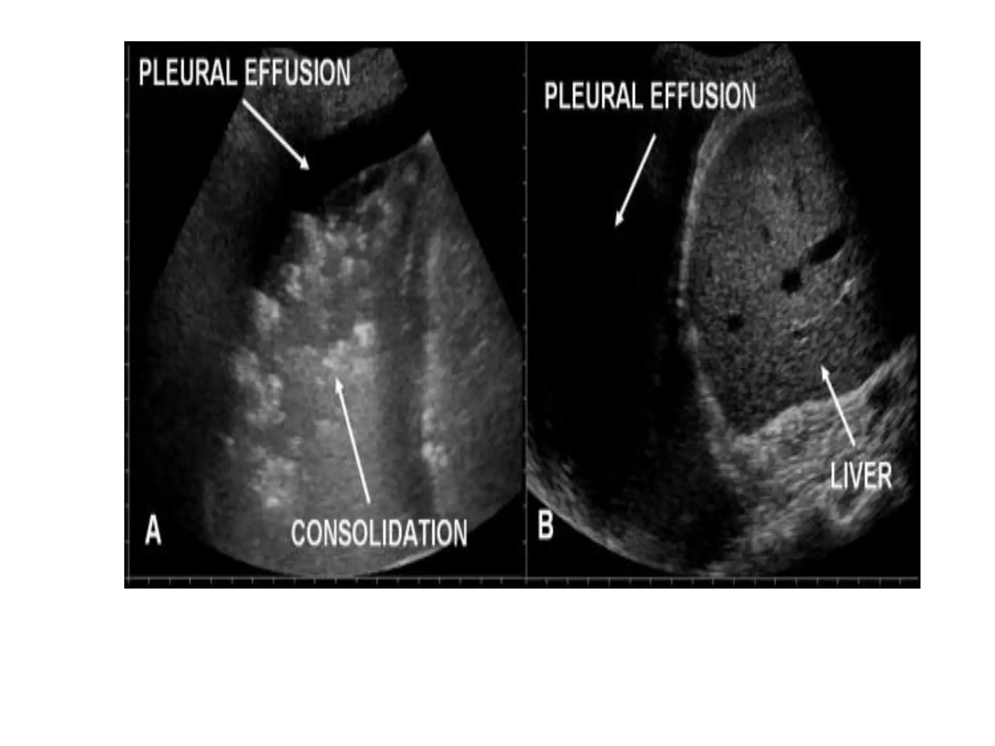 Lung Ultrasound | PDF