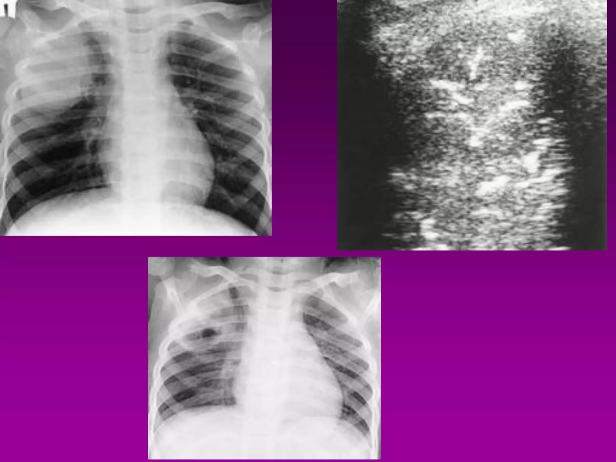 Lung Ultrasound | PDF