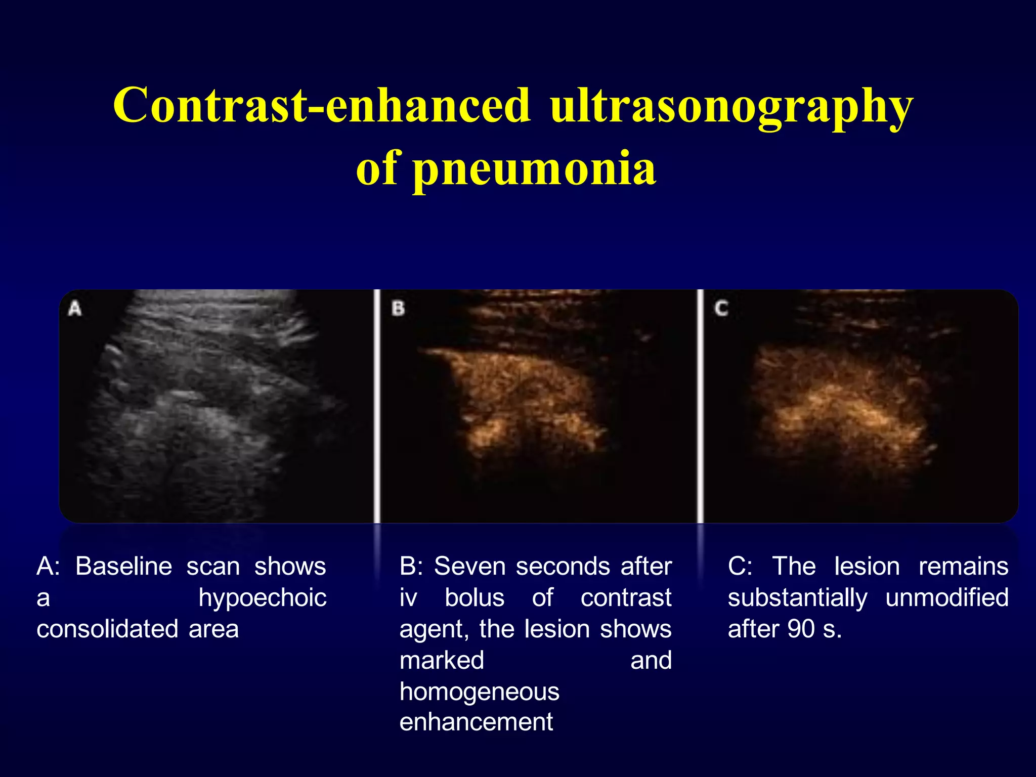 Lung Ultrasound | PDF