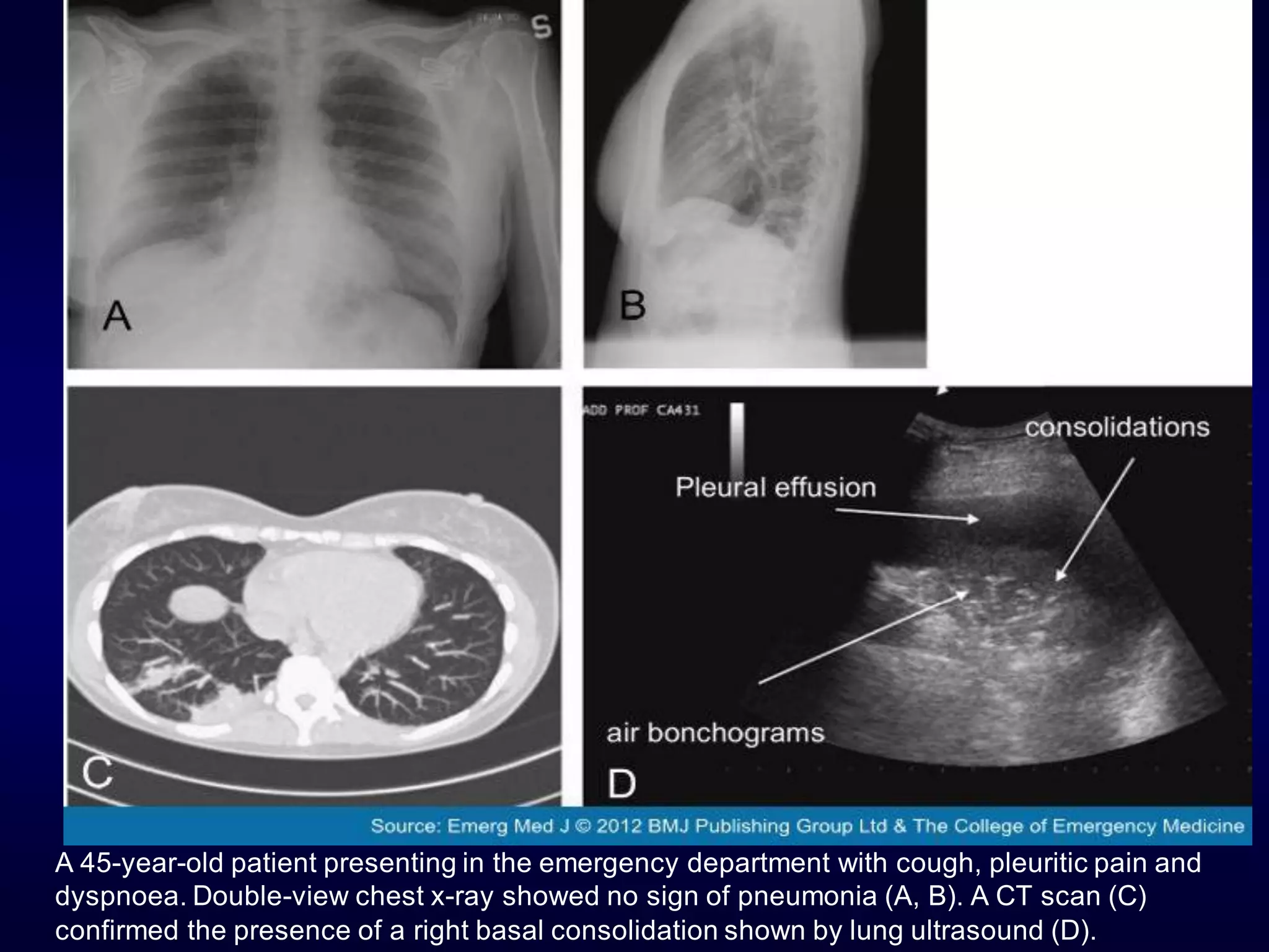 Lung Ultrasound | PDF