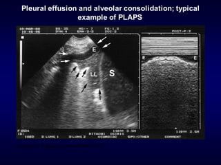 Lung Ultrasound | PDF
