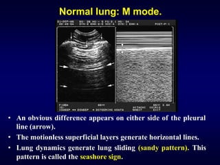 Lung Ultrasound | PDF