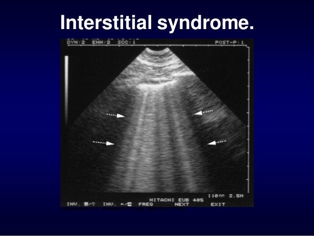 Lung Ultrasound