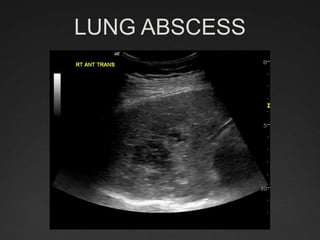 Lung ultrasound | PPTX