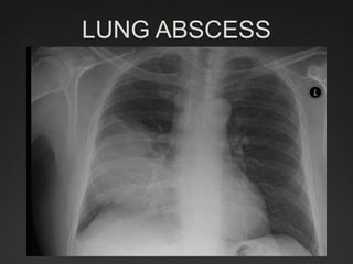 Lung ultrasound | PPTX