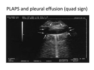Lung ultrasound | PPTX