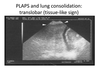 Lung ultrasound | PPTX