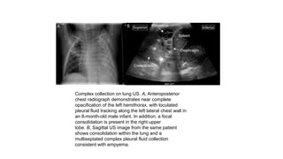 Lung Ultrasound sings and procedure.pptx