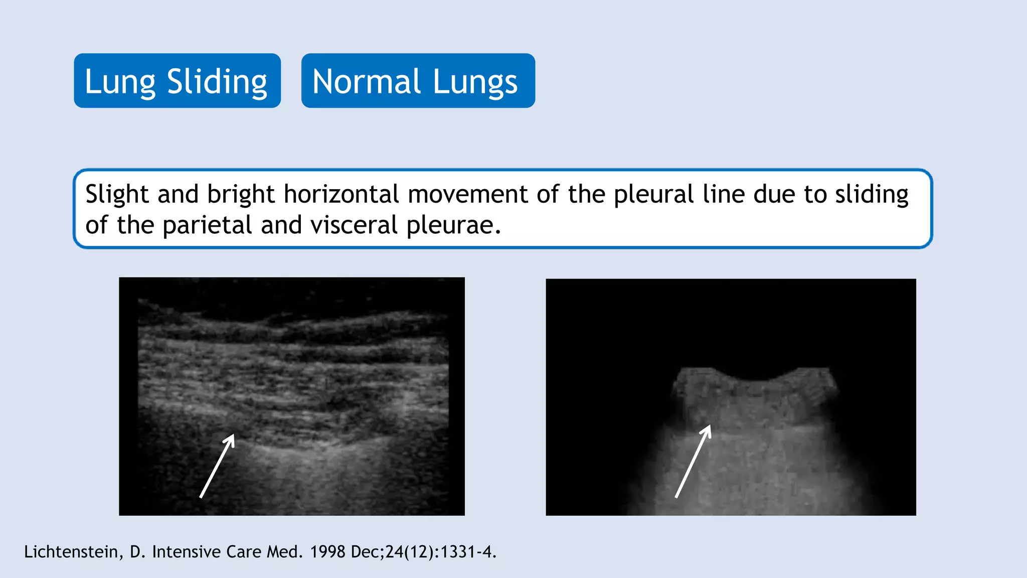 Lung Ultrasound in Cardiac Care | PPT | Free Download