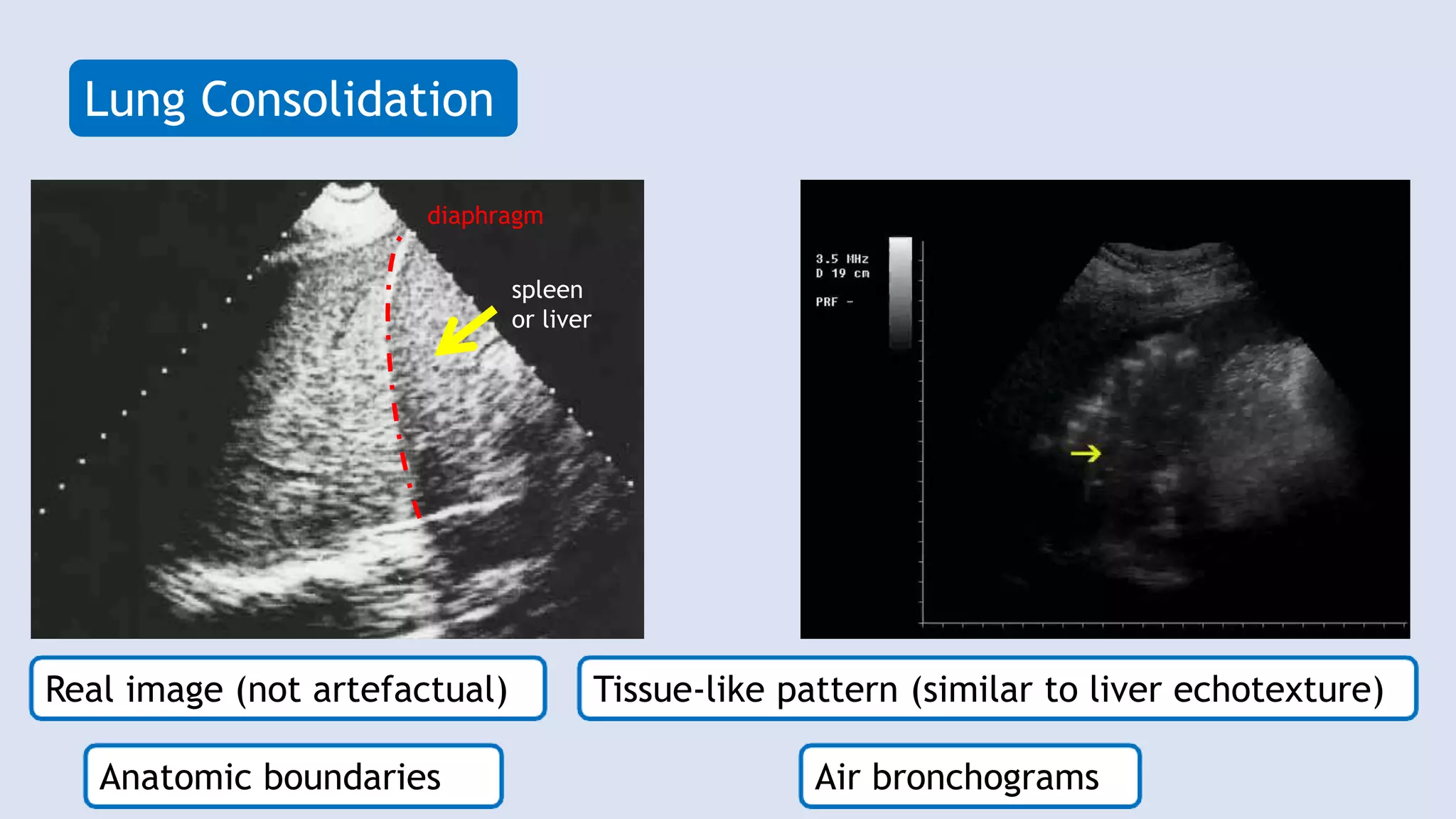 Lung Ultrasound in Cardiac Care | PPT | Free Download