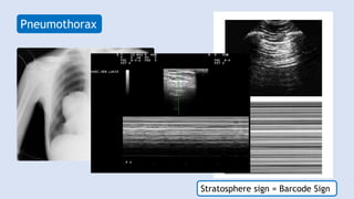Lung Ultrasound in Cardiac Care | PPTX