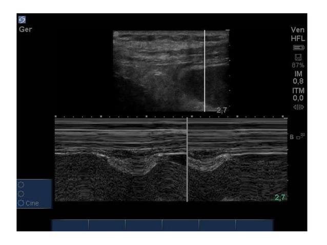 Principles of Lung Ultrasound | PPTX
