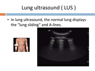 Lung ultrasound for diagnosis of pneumonia | PPTX
