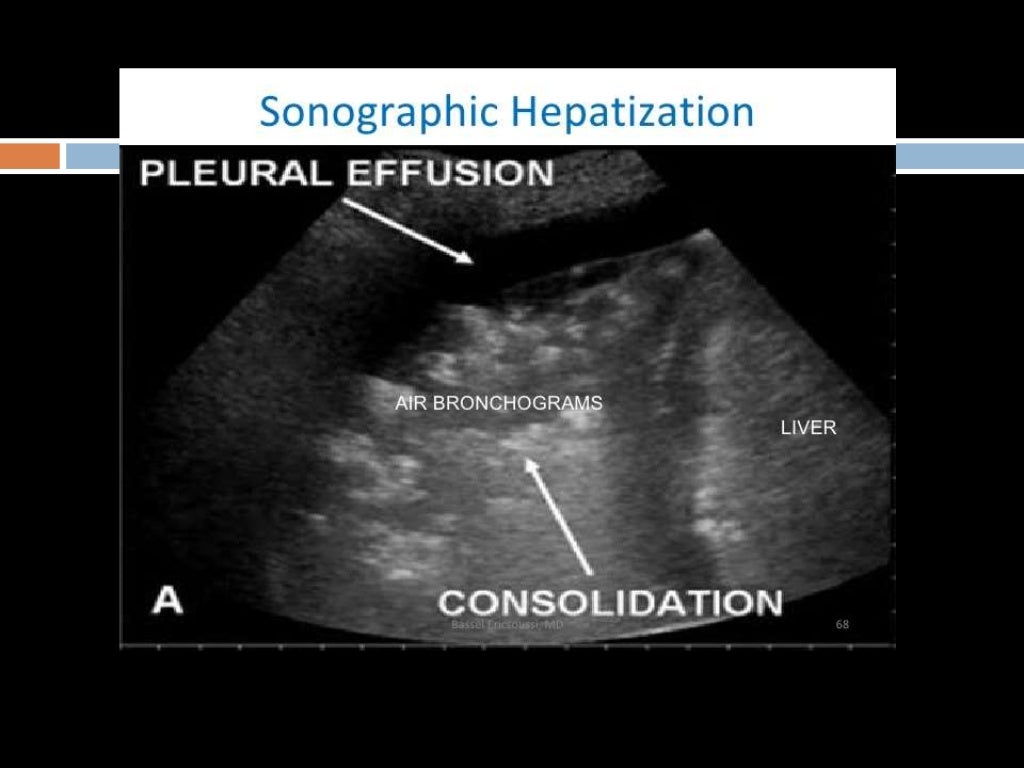 Lung ultrasound for diagnosis of pneumonia