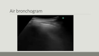 Lung Ultrasonography in COVID patient.pptx