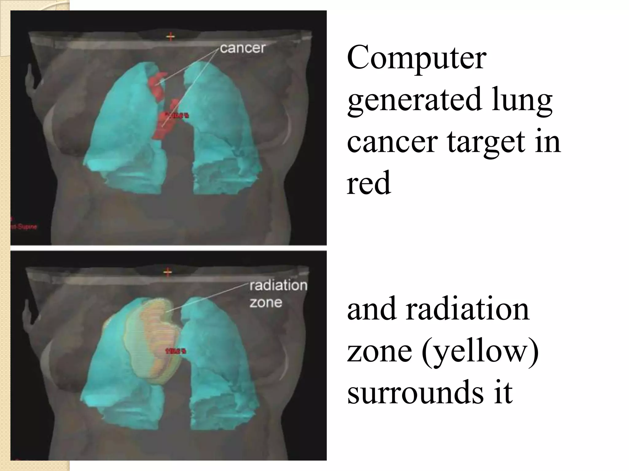 Radiation for Lung Cancer | PPTX