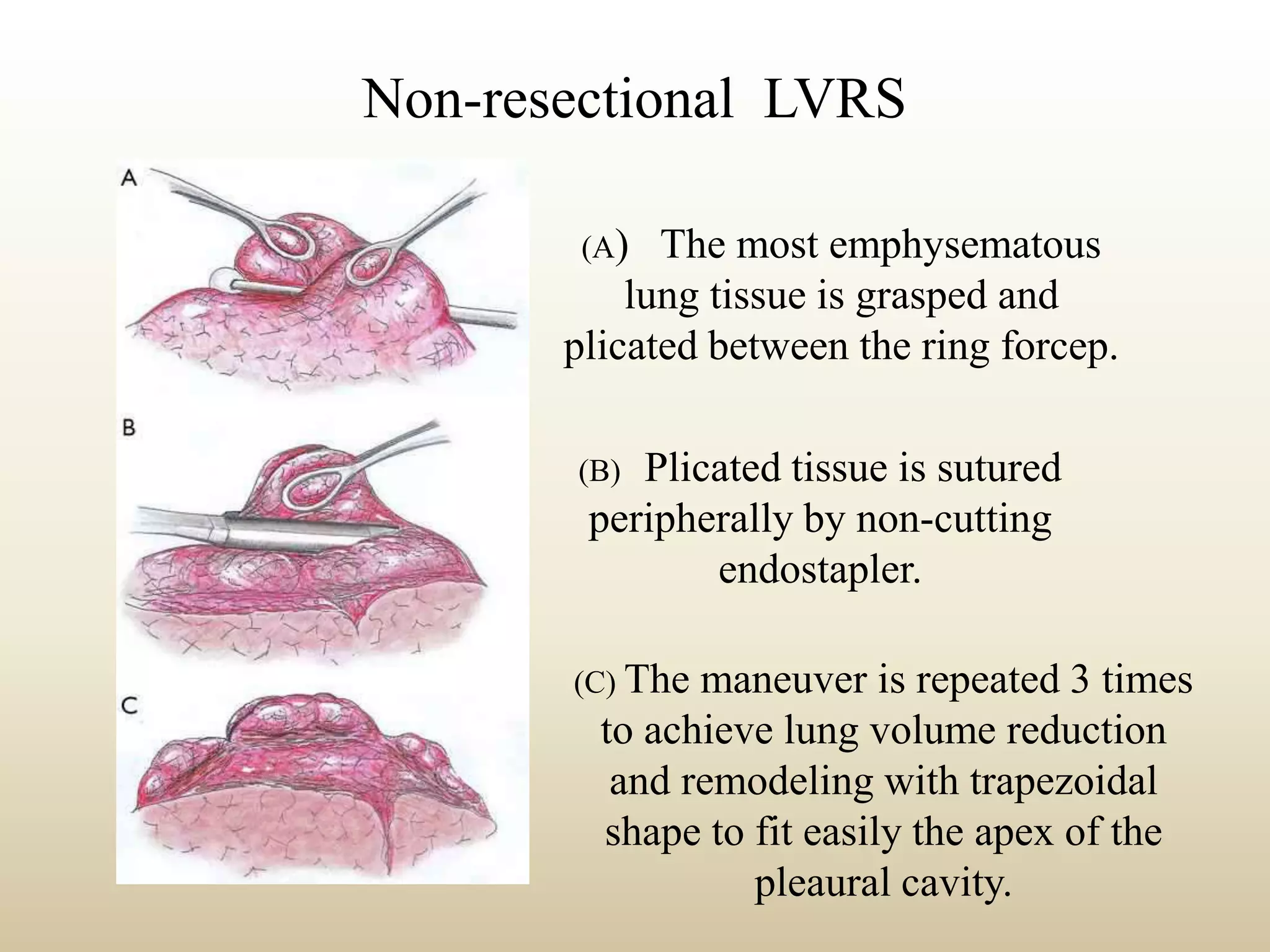 Lung volume reduction surgery (2) | PPTX