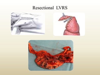 Lung volume reduction surgery (2) | PPTX
