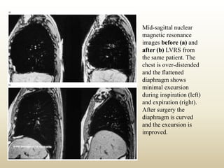 Lung volume reduction surgery (2) | PPTX