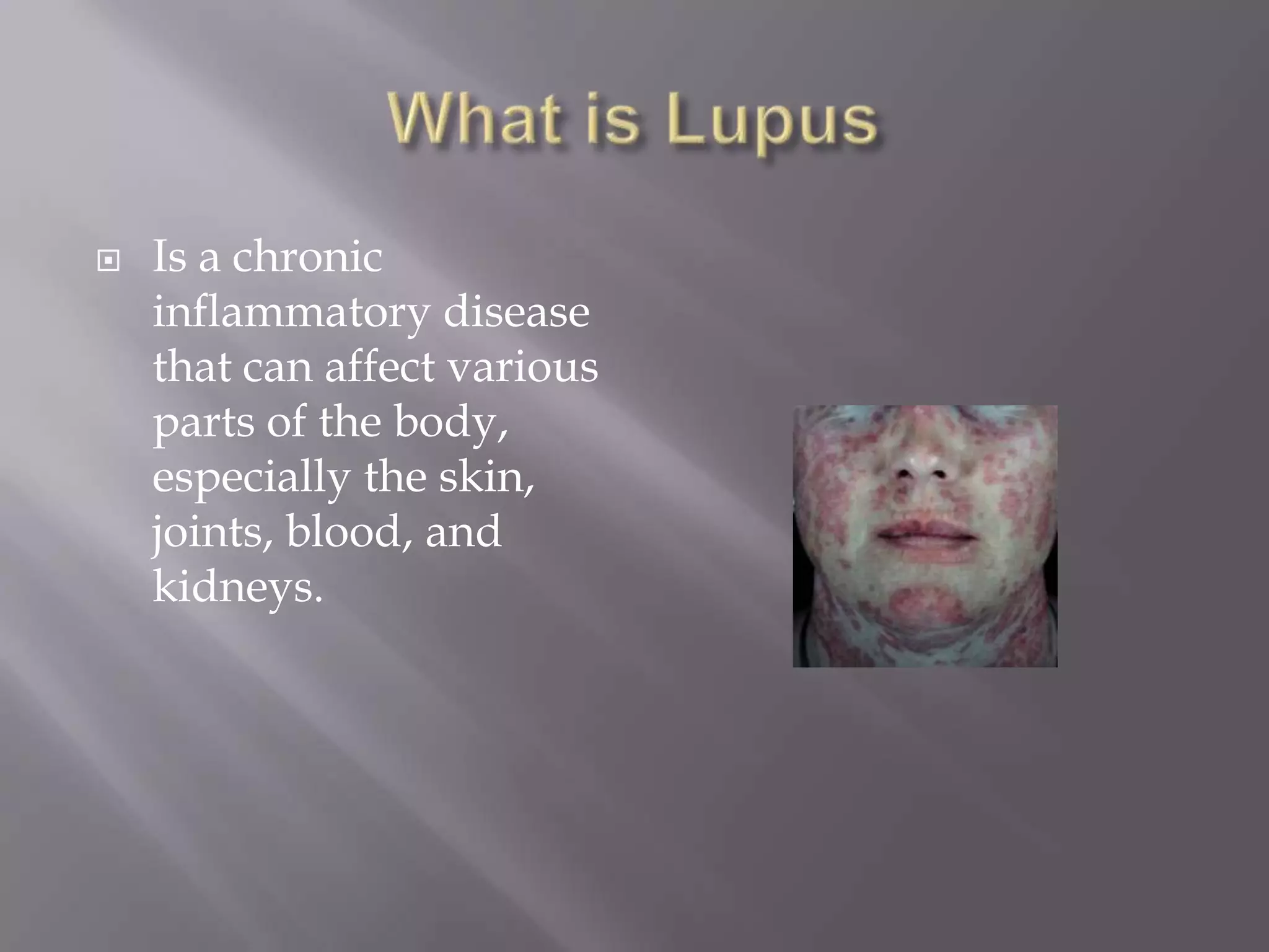 Lupus | PPT
