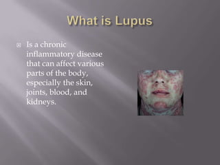 Lupus | PPTX