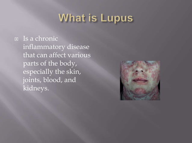 Lupus | PPT