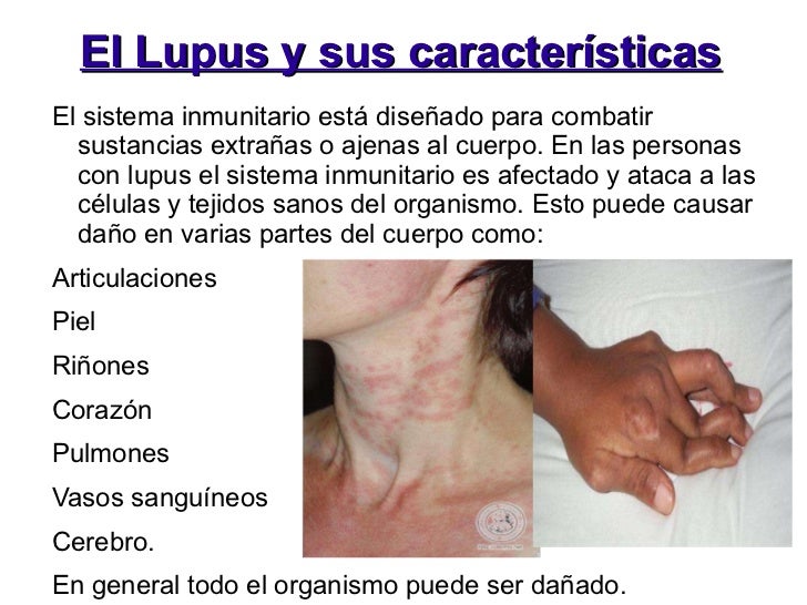 ¿Cuáles Son Las Causas Del Lupus – QMHAN