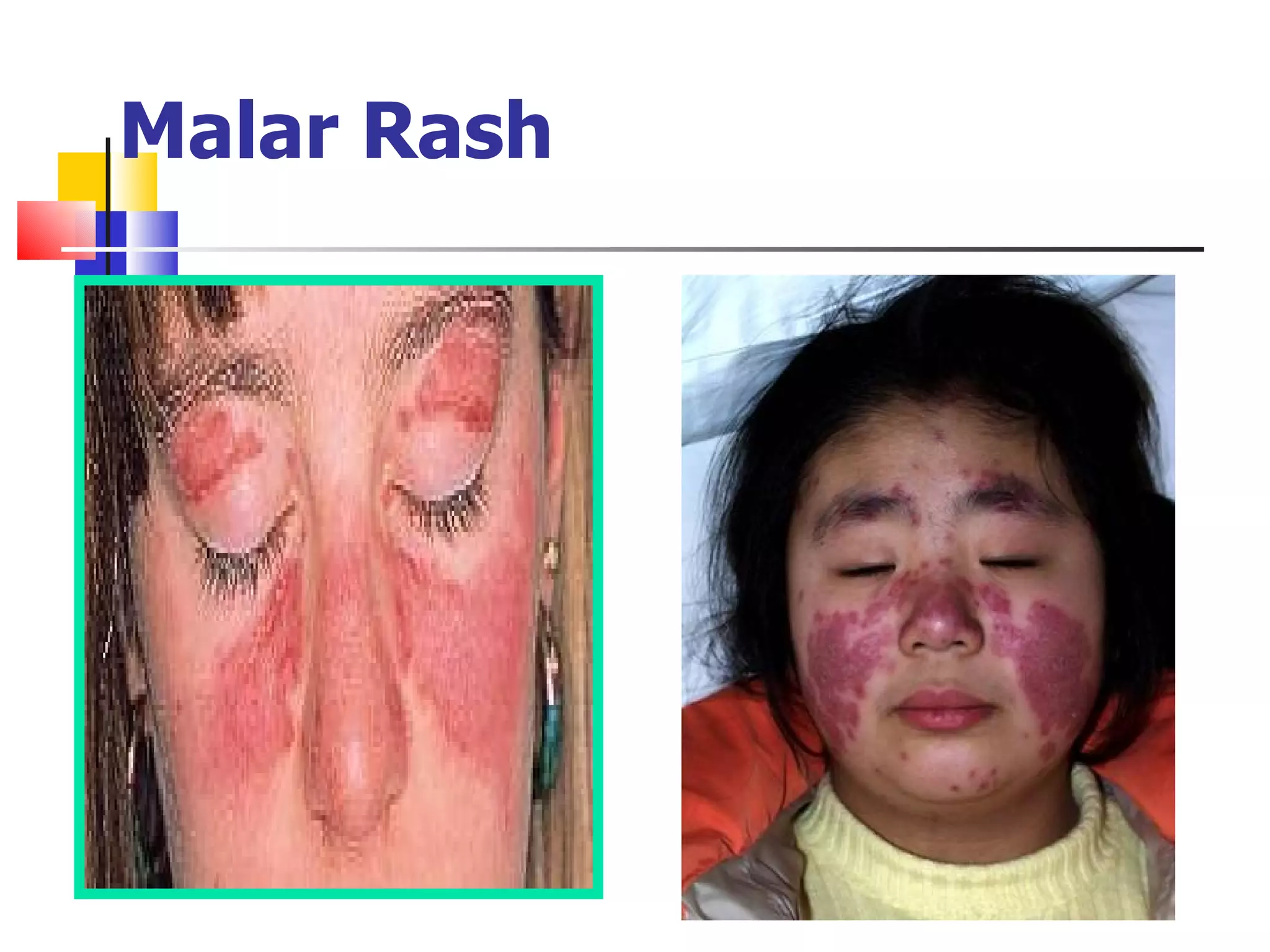 SLE | PPT | Skin and Dermatology | Diseases and Conditions