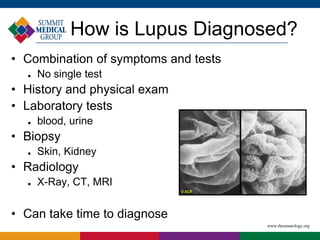Lupus | PDF