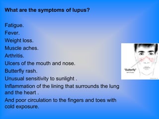 systemic lupus erythematosus | PPT
