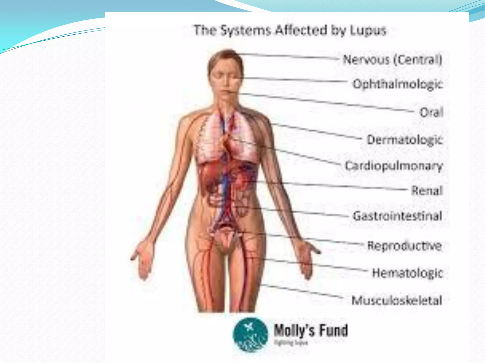 LUPUS | PPT