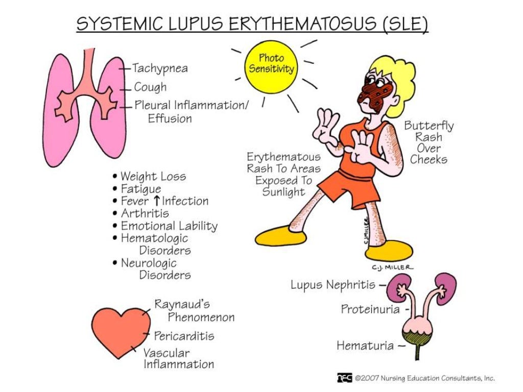 Lupus Nephritis :From Basics To Practice