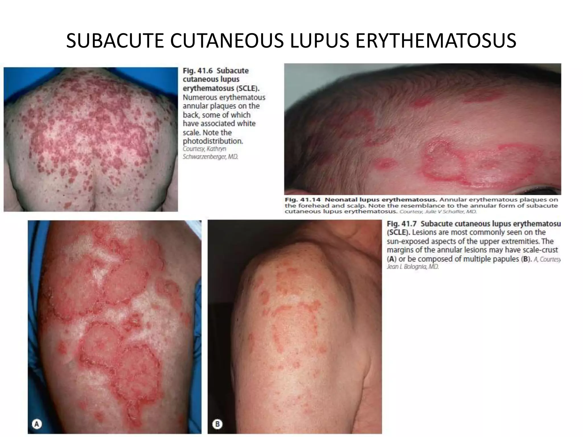 Lupus Erythematosus for dermatologists | PPTX