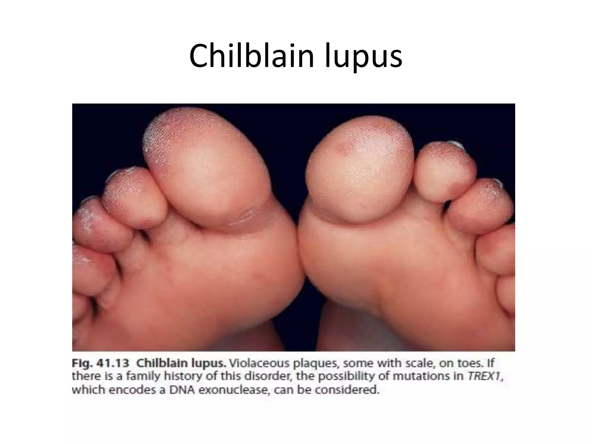 Lupus Erythematosus for dermatologists | PPTX
