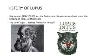 Lupus | PPT