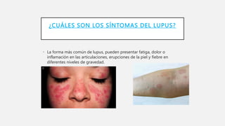 lupus.pptx