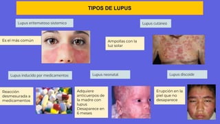 Lupus.pptx