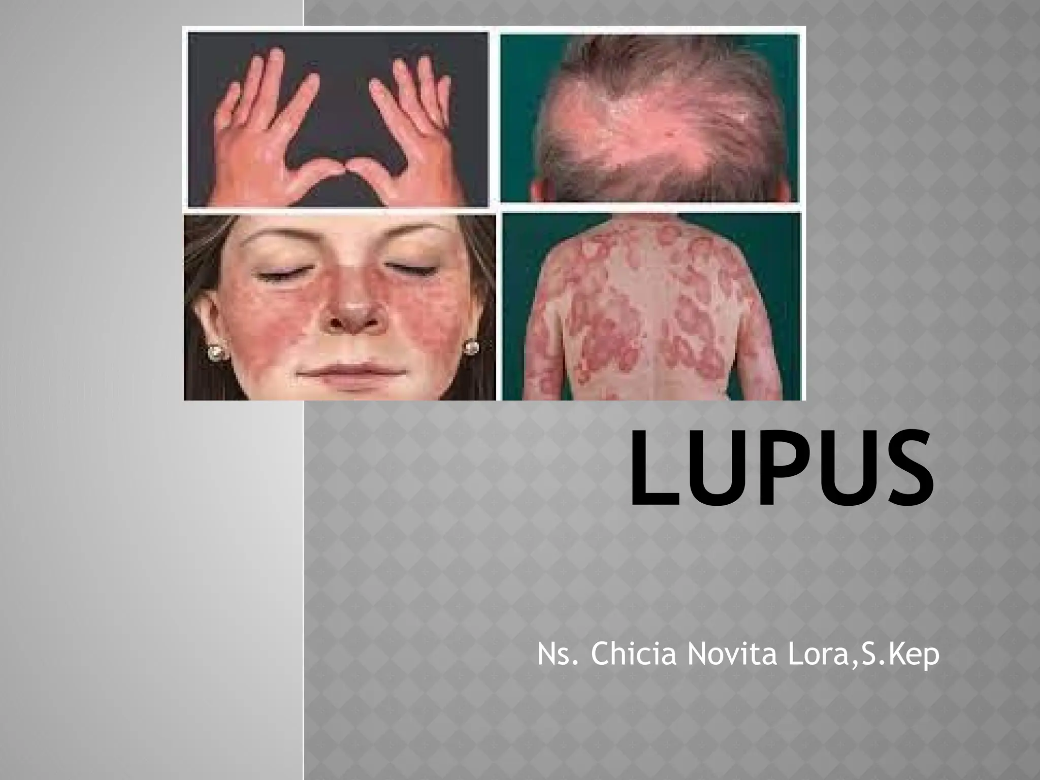 pemeriksaan klinis pada penyakit autoimun | PPTX