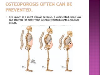 Lupus.and.bonehealth | PPT | Bone and Joint Conditions | Diseases and ...
