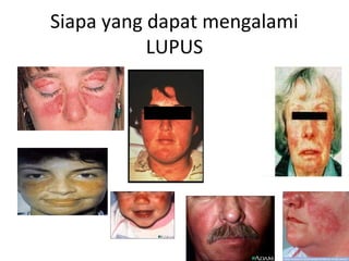 apa dan bagaimana lupus ? | PPT