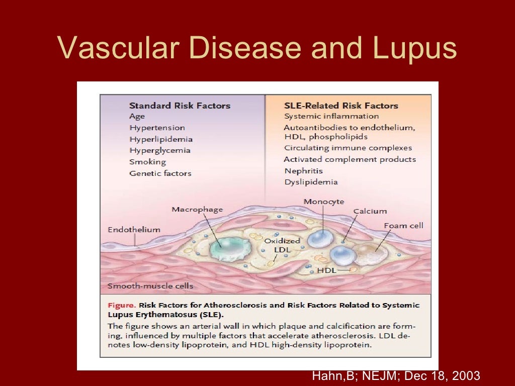 Lupus and cardiovascular disease