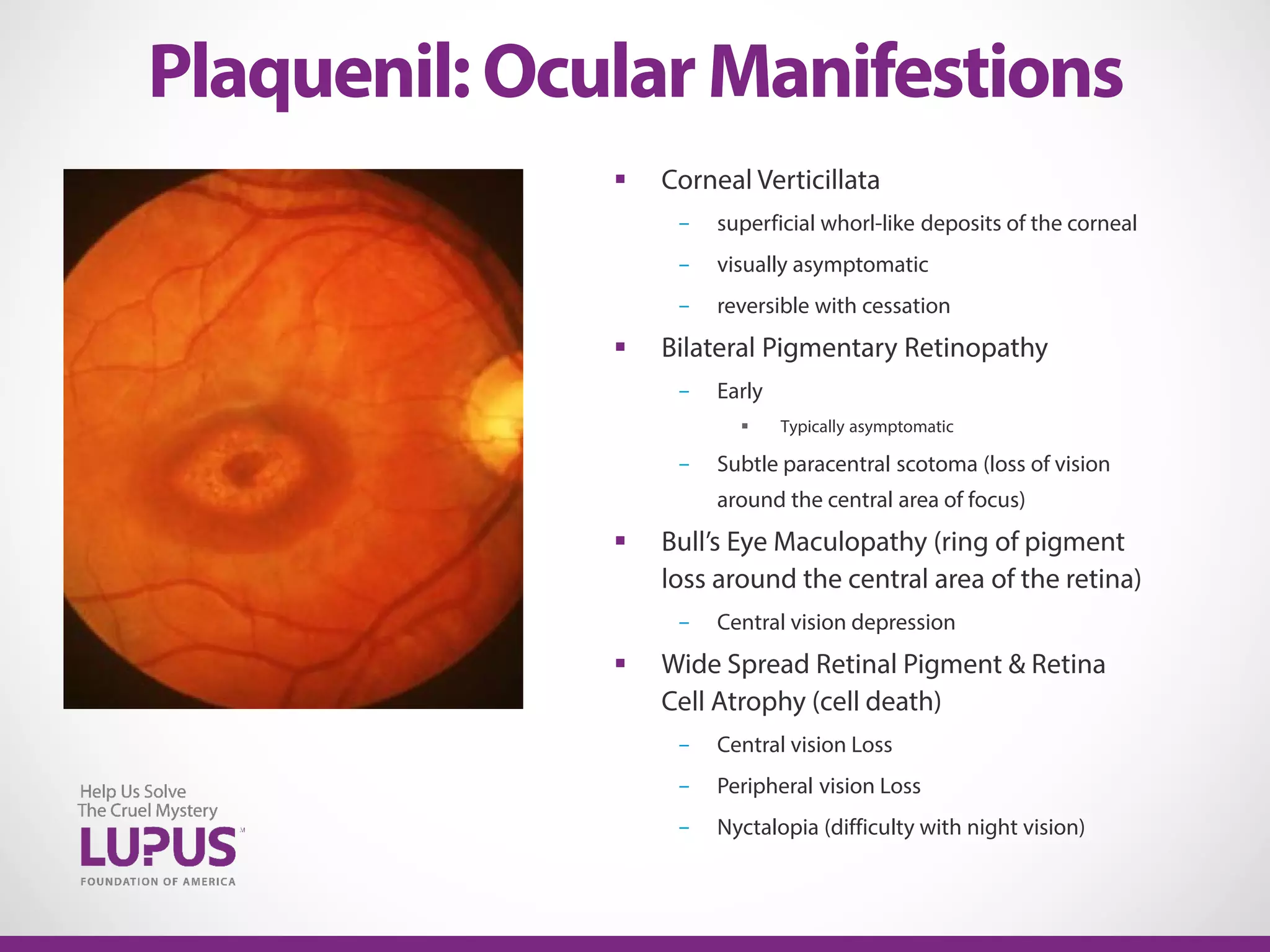 Lupus and the Eye | PDF