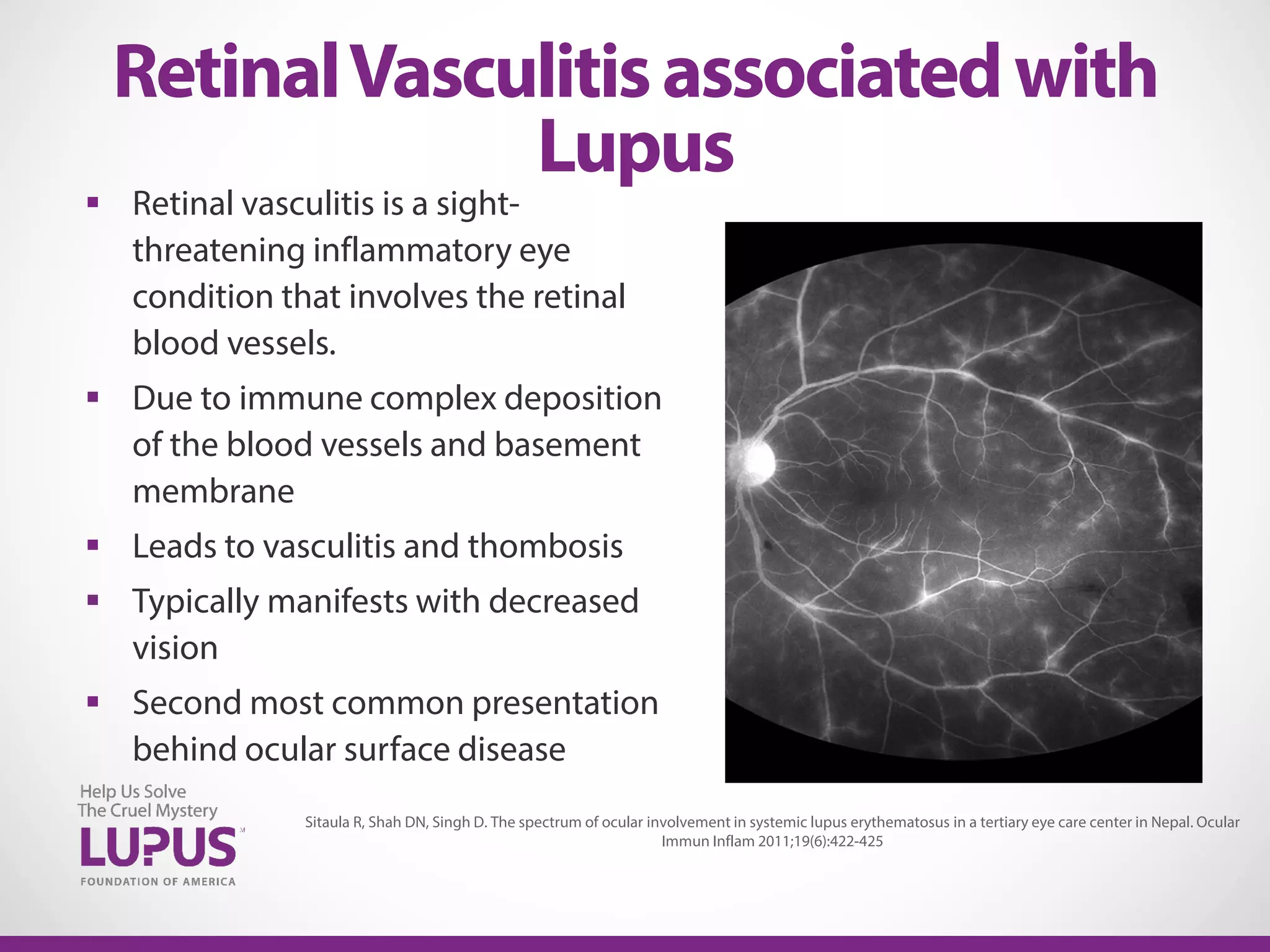 Lupus and the Eye | PDF