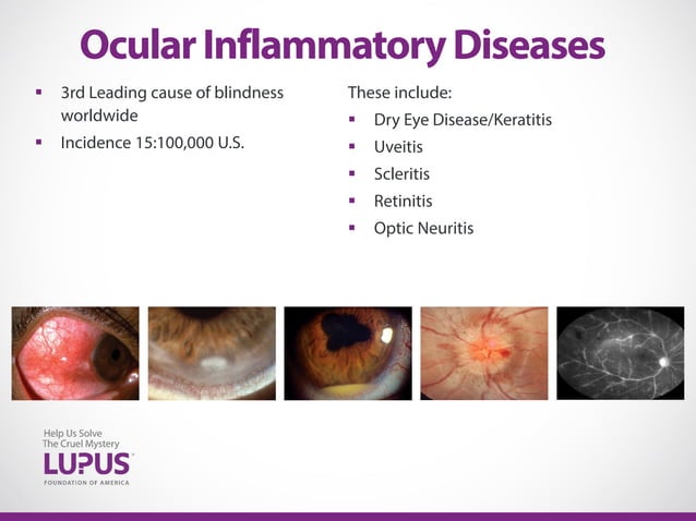 Lupus and the Eye | PPT