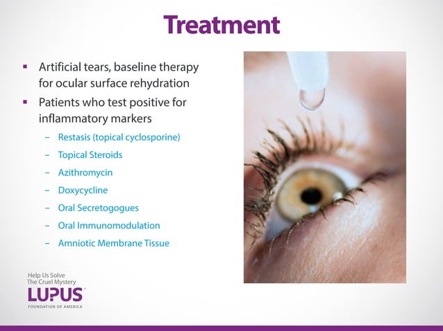 Lupus and the Eye | PPT