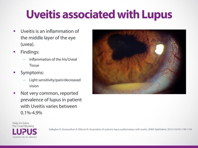 Lupus and the Eye | PPT
