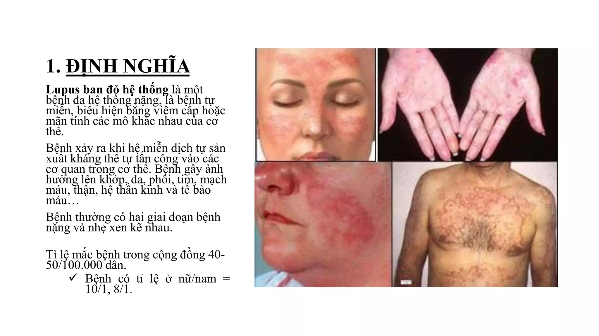 LUPUS BAN ĐỎ HỆ THỐNG (2).pptx