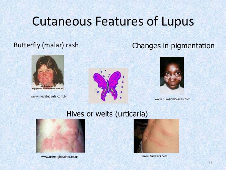 Lupus Malar Rash Treatment Bimalar Facial Rashes Clinical Advisor