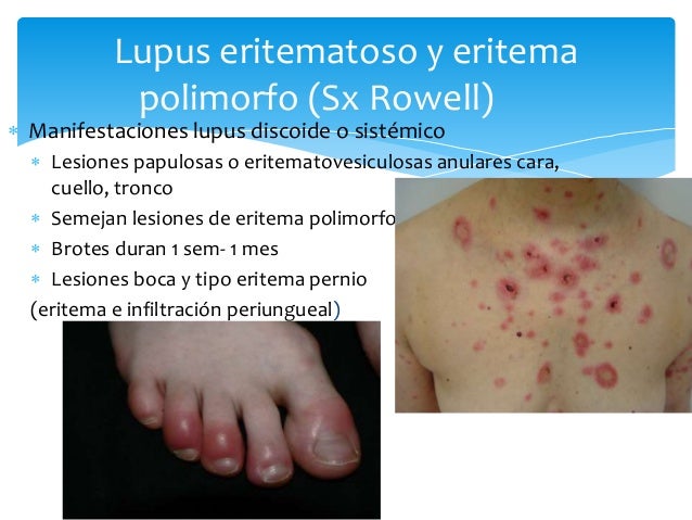 Lupus Pernio Images